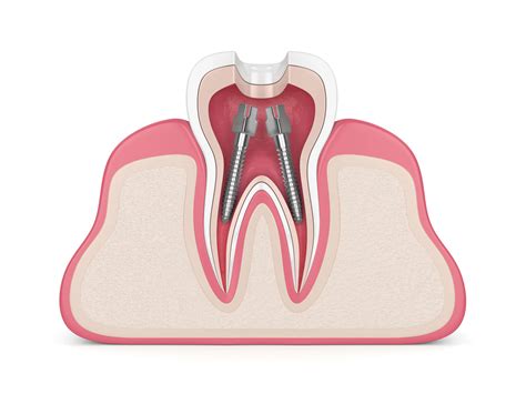 What Is A Root Canal Procedure