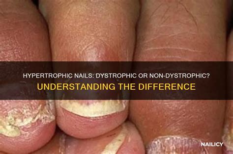 Hypertrophic Nails Dystrophic Or Non Dystrophic Understanding The