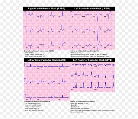 Criteria For Lbbb Rbbb Lafb Lpfb 42nd Street Photo Hd Png Download Vhv