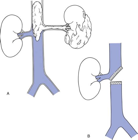 Surgical Reconstruction Of The Inferior Vena Cava And Iliofemoral