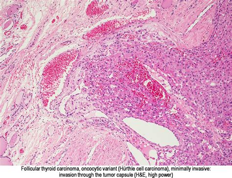 Pathology Outlines Oncocytic Hürthle Cell Tumors