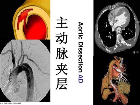生活中常见急性重症之一 主动脉夹层 知乎