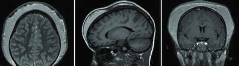 A Axial T2 Mri Brain Demonstrating Bilateral Subgaleal Fluid