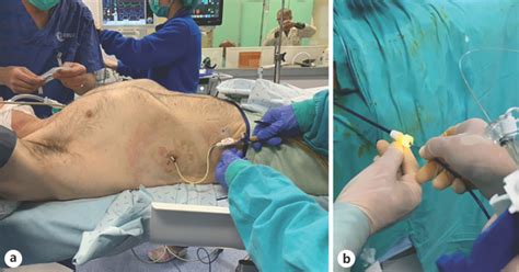 Percutaneous Transhepatic Cholangioscopy And Lithotripsy Of