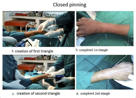 Percutaneous Pinning