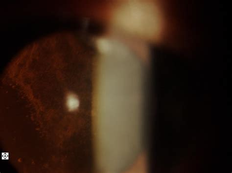 Posterior Subcapsular Cataract Sonoran Desert Eye Center