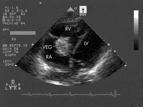 Eustachian Valve Echo Subcostal View