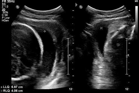 Amniotic Fluid Ultrasound