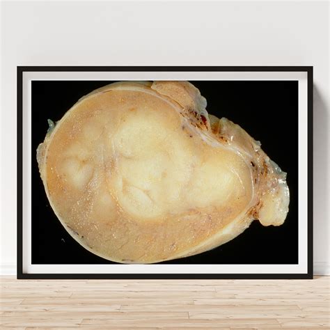 Gross Specimen Sectioned Testis With Seminoma Art Print By Science Photo Library Science