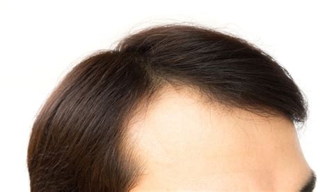 Transgender Individuals Best Hair