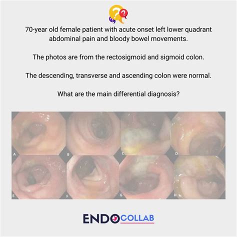 Endocollab™ Gastroenterology And Endoscopy Education On Linkedin 70f