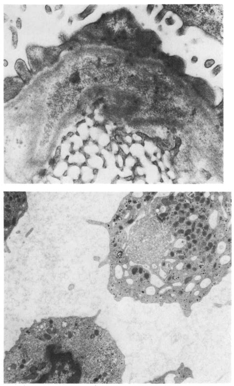 Electronmicrograph Of Glomerular Basement Membrane Showing Lamellation