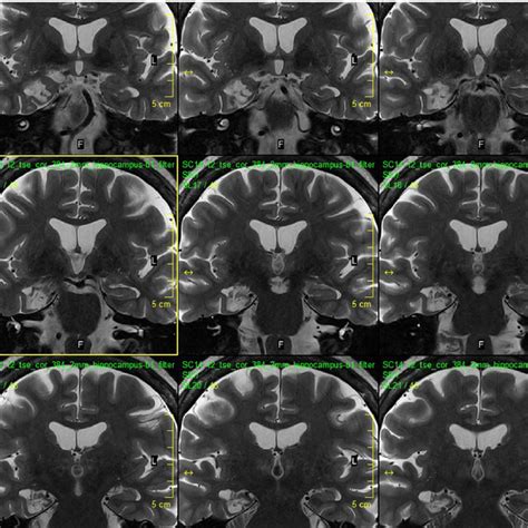 Post Surgery Seizure Outcome Engel Classification Class I Download Scientific Diagram