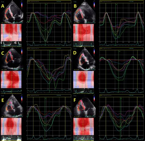 Echocardiography Derived Right Ventricular Global Longitudinal Strain Download Scientific