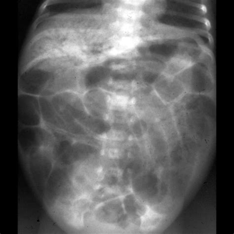Necrotizing Enterocolitis Pediatric Radiology Reference Article