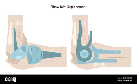 Joint Implantation Injured Or Distracted Human Joint Replaced With