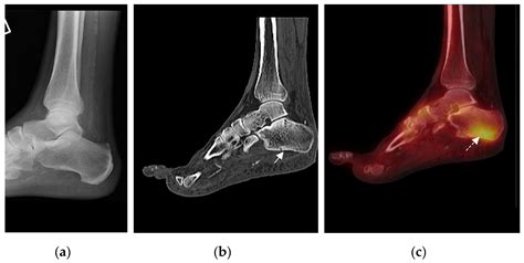 Acute Charcot Foot
