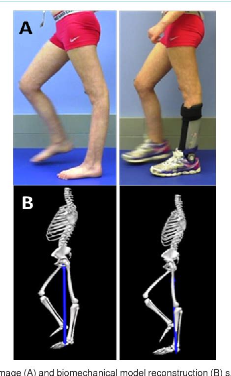 Figure 1 From Effects Of An Articulated Ankle Foot Orthosis On Gait