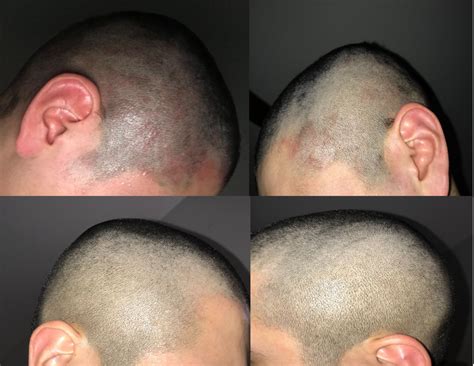 417 Best Rdandruff Images On Pholder What Is Going On As My Head