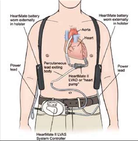 Diagrammatic Representation Of A Left Ventricular Assist Device In Situ
