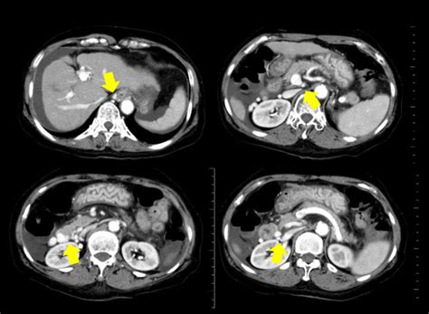 Initial Abdominal Computed Tomographic Images Showing Paraesophageal