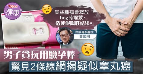 【睾丸癌】男子貪玩用驗孕棒驚見2條線 網揭疑似睾丸癌