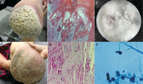 Phaeohyphomycosis In China Pmc