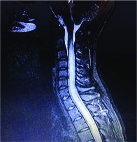 Sagittal T2 Weighted Magnetic Resonance Imaging Mri Of The Cervical