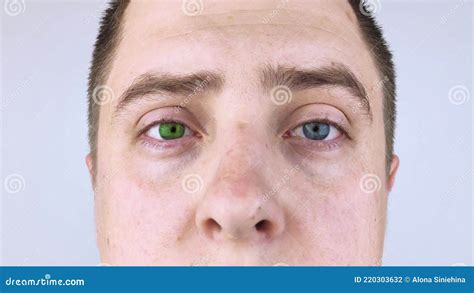 A Man With Different Color Eyes Looks Into The Frame The Right Eye Is