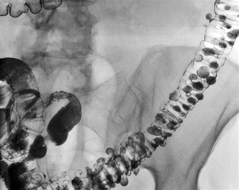 Diverticulitis X Ray Stock Image C019 4457 Science Photo Library