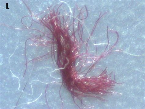 Morgellons Synopsis Of Fiber Specimens