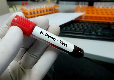 La Helicobacter pylori prevenir y curar las bacterias que causan úlceras