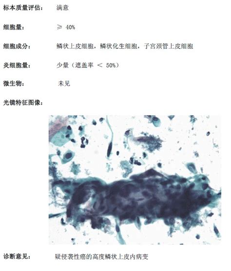 宫颈cinⅢ级，局灶微浸润，累及腺体 数字病理远程诊断与质控平台