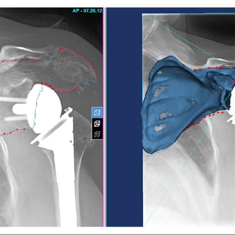 Radiograph Registration To 3d Ct Radiographs Were Registered To Download Scientific Diagram