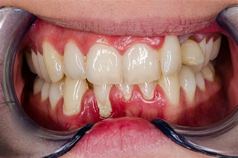 Gingivitis Causas Y Tratamiento Curaprox