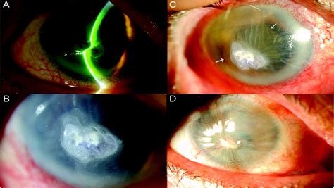 Silicone Oil Induced Corneal Perforation Following Complex R
