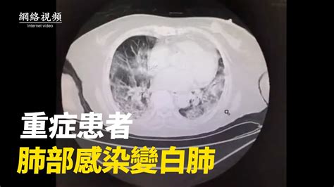【焦點】肺部感染變白肺🎯協和醫生悲觀：能做的不多😨 奧密克戎典型症狀是上呼吸道感染，一般不會進入肺部；然而，中國近日不斷出現重症患者（或