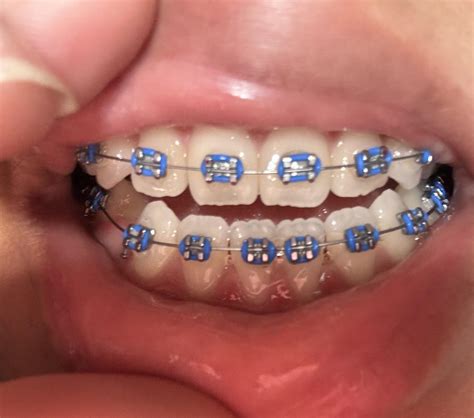 Finally Closing Extraction Gap R Braces