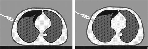 Lung Ultrasound And The Blue Protocol Crashing Patient