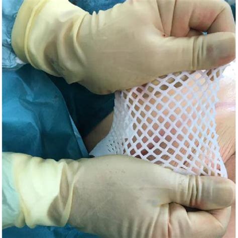 Photograph Of A Woman Who Had Delayed Tissue Expander Placement 6 Weeks