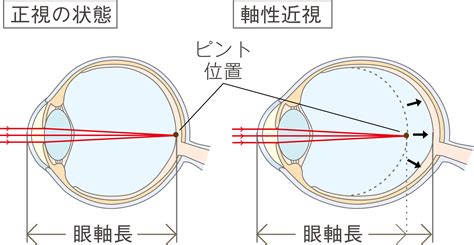 小児の近視抑制治療（低濃度アトロピン001点眼治療）について 【ときわ駅前なかむら眼科】京福電鉄 常盤駅からすぐの眼科・日帰り手術・土曜診療