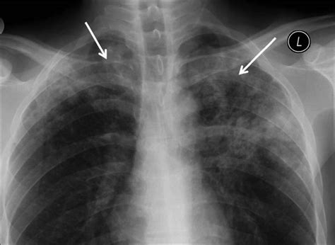 Case Report Acute Tuberculous Laryngitis Presenting As Acute