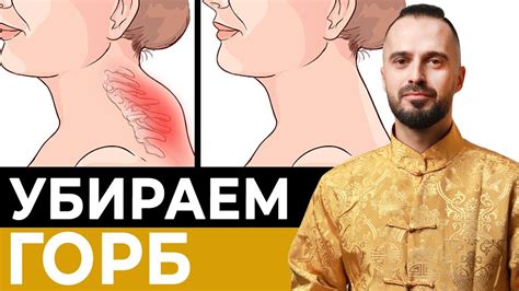 Как убрать горб на спине 2 простых упражнения которые сможет