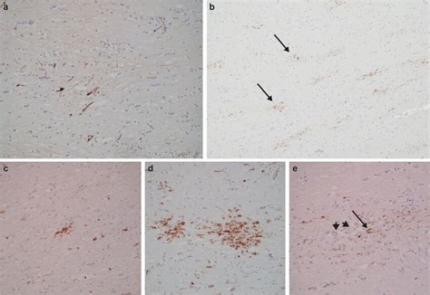 Histopathologic Evidence Of Recent And Old Diffuse Axonal Injury In