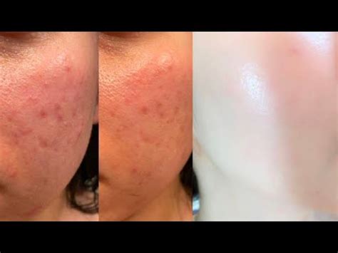 Make Your Acne Disappear Overnight DIY Cream To Remove Acne Pimples