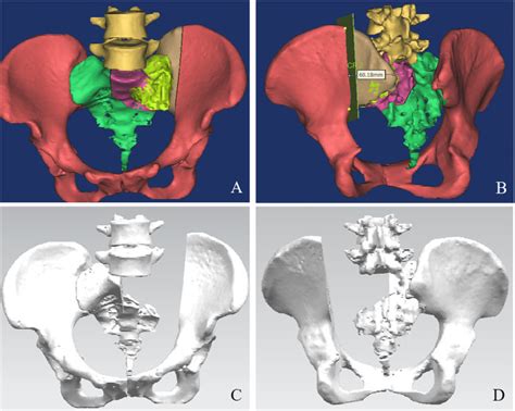 Reconstruction After Hemisacrectomy With A Novel 3d Printed Modular