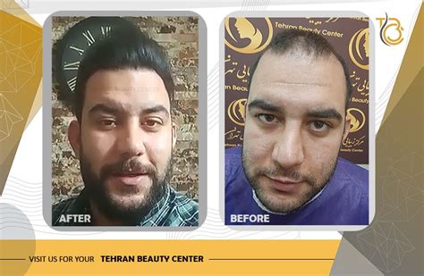 گالری تصاویر کاشت موی طبیعی