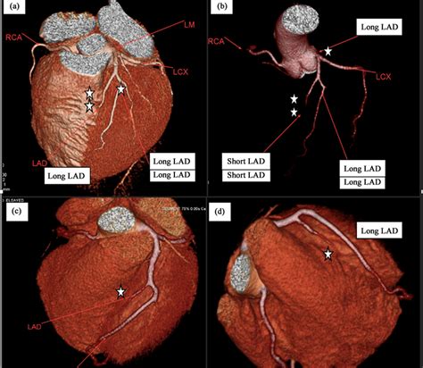 Coronary Artery Anomalies Detected By Multi Detector Computed