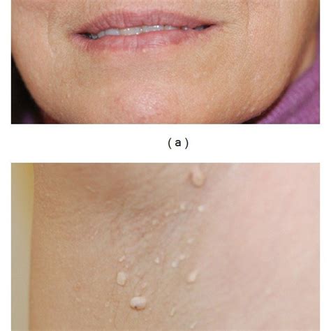 Characteristic Multiple Dome Shaped Papules On The Nose And Cheek Of A