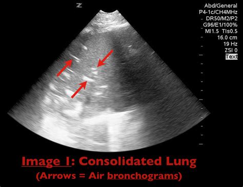 Hepatization Of Lung